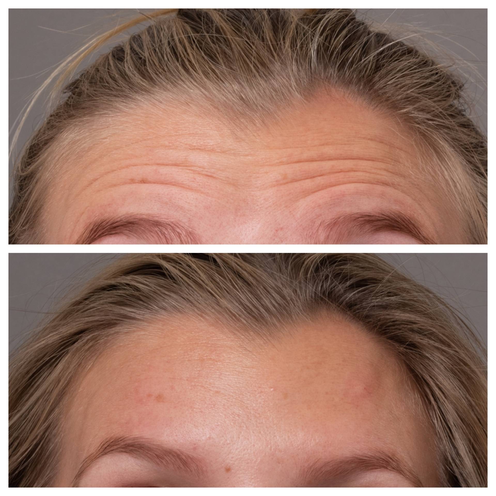 Wrinkle Relaxer Consultations – Southern Cosmetics